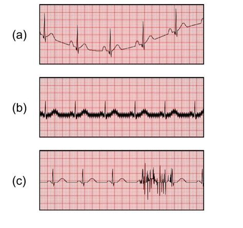 Ecg Artifact Examples A Baseline Wander B Power Line Download Scientific Diagram