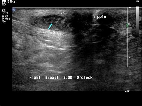 Sebaceous Cyst Vs Lipoma Ultrasound