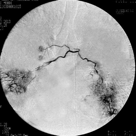Cxr Shows Multiple Bilateral Well Defined Pulmonary Nodules And Masses