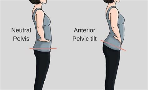 Anterior Pelvic Tilt