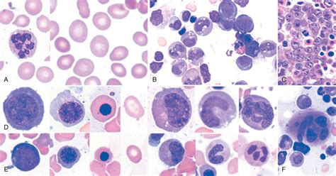 Megaloblastic Anemias Clinical Tree