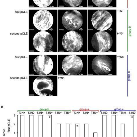 Pcle In Patients After Chemotherapy Treatment A Representative Pcle Download Scientific