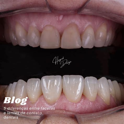 5 Diferenças Entre Facetas E Lentes De Contato Dental Donegá