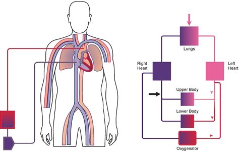 Configurations Of ECMO Alfred ECMO Guideline