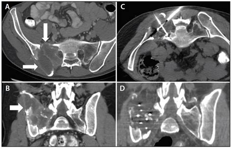 Metastatic Osseous Disease Current Interventional Oncology Treatment Options Endovascular Today