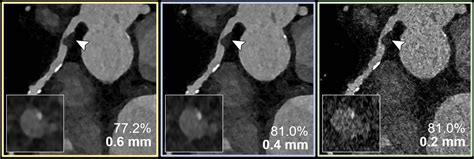 Photon Counting Ct Found To Improve Coronary Artery Disease Assessment