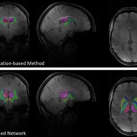 The Causal Diagram Of The Deep Brain Structures Segmentation Workflow Download Scientific Diagram