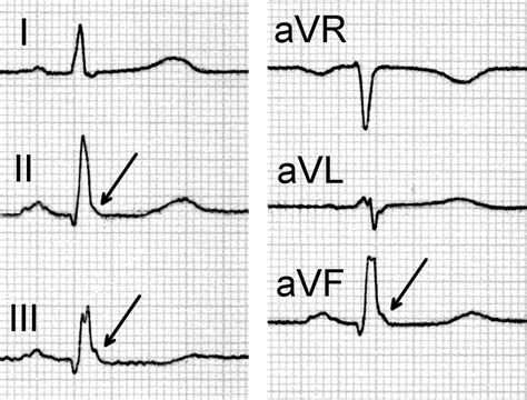 Impact Of Age And Sex On The Long Term Prognosis Associated With Early