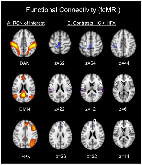 Functional Connectivity Between Group Differences A Resting State Download Scientific