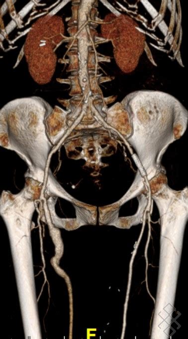 Angioscanner Des Membres Inférieurs Définition And Déroulement Prise De Rdv En Ligne