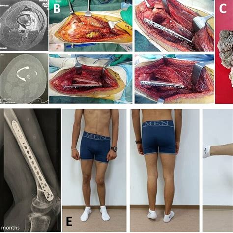 A Ewing Sarcoma Of The Distal Right Fibula With Purely Intraosseous
