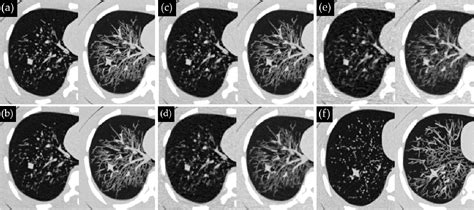 Figure 2 From Detectability And Volumetric Accuracy Of Pulmonary Nodules In Low Dose Photon