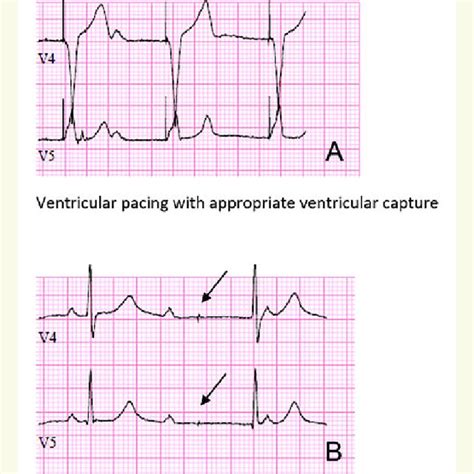 Pdf Case Series Of Late Lead Dislodgement Of Medtronic Selectsecure