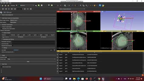 Sajad Amiri On Linkedin Tumor Segmentation And Extracting Radiomics Feature Of Tumor By 3d Slicer
