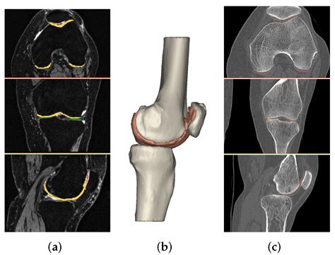 Mri Images Of Problem Knee