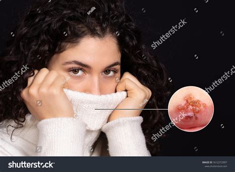 4 Herpex Simplex Virus Gambar Foto Stok And Vektor Shutterstock