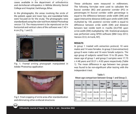 Vertical Lines Showing A Smile Width Sw B Distance Between The