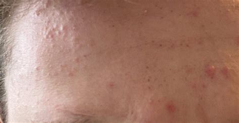 Kleine Pickel An Der Stirn Werden Immer Schlimmer Haut