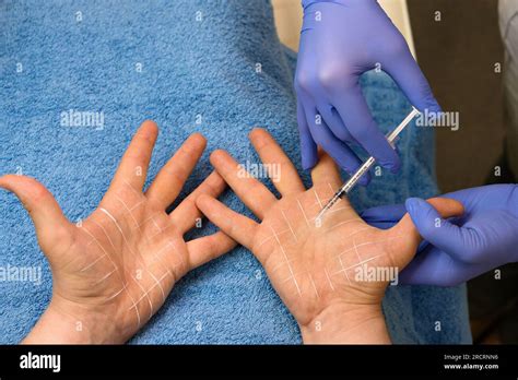 Esthetician Makes Injections Of Botulinum Toxin In Palm Against
