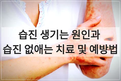 습진 생기는 원인과 습진 없애는 치료 및 예방법