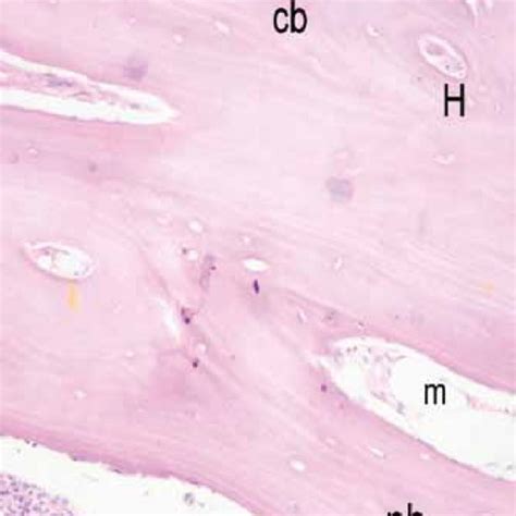 A Photomicrograph Of A Section From The Iliac Crest Bone Of A Normal