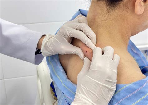 Ứng DỤng KỸ ThuẬt ChÍch LỂ Trong ĐiỀu TrỊ Bệnh Viện Yhct Nghệ An