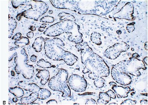 Adenosis And Sclerosing Lesions Oncohema Key