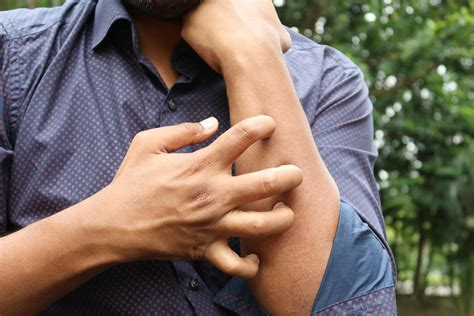 Exploring Phototherapy For Managing Chronic Spontaneous Urticaria