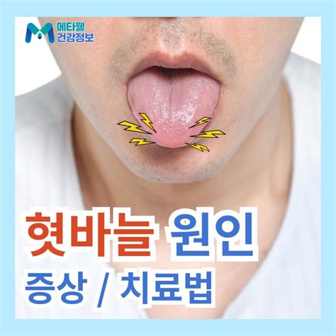 혀를 바늘로 콕콕 찌르는 듯한 혓바늘 왜 생길까 원인 증상 혓바늘 낫는법 네이버 블로그