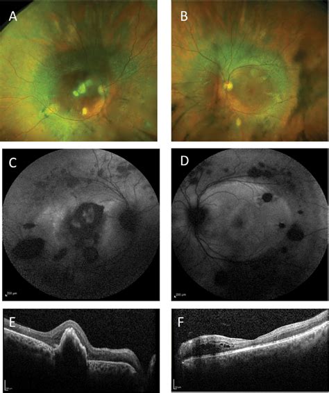 Retinal Imaging Demonstrates Some Atypical Features Of Escs A B The Download Scientific