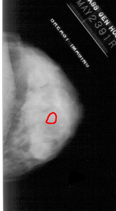 Figure 1 From A Microcalcification Enhancement Method For Mammogram Images Semantic Scholar