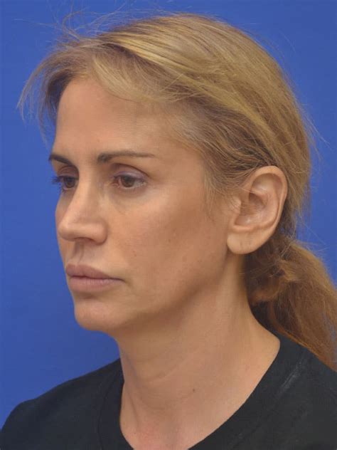 Face Lift Before After Photos Boca Raton FL Berman Plastic Surgery Spa