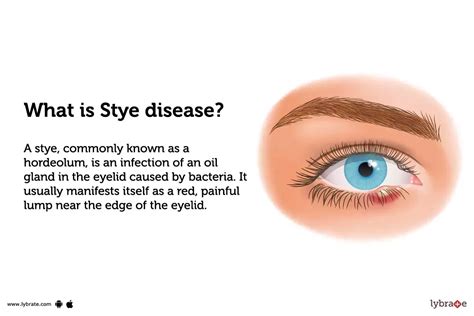 Stye Causes Symptoms Treatment And Cost