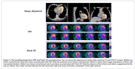Quantitative Comparison Of Myocardial Perfusion Defects Using Dif