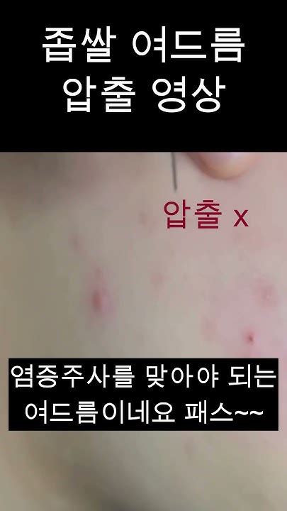 진스킨 좁쌀 여드름 압출 영상16 압출영상 Blackheads 피지압출 Shorts Youtube