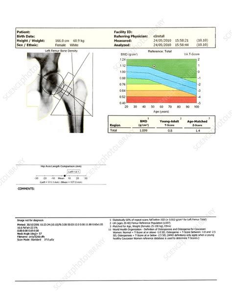 Bone Density Scan Stock Image C Science Photo Library