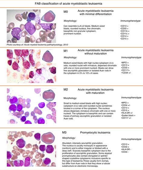 Morphology Of Leukaemias Revista Médica Del Hospital General De