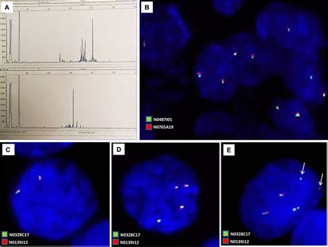 Systemic Alk Alcl Myxoid Type A Molecular Analysis By Gene