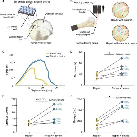 Python Tooth Inspired Fixation Device For Enhanced Rotator Cuff Repair Science Advances