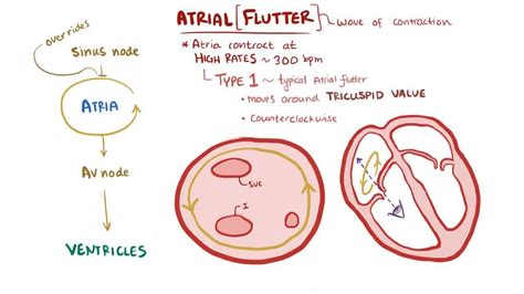 Video Atrial Flutter Osmosis