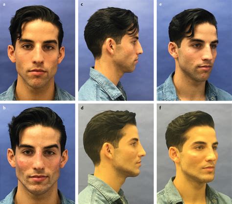 Facial Male Plastic Surgery Telegraph