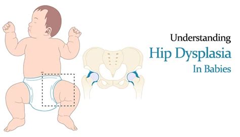 Understanding Hip Dysplasia In Babies Accord Hospital