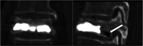 Delayed Onset Of Anterior Spinal Artery Syndrome Caused By Retropulsed
