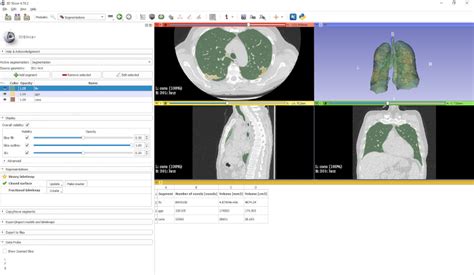 Lung Ct Segmentation To Identify Consolidations And Ground Glass Areas For Quantitative