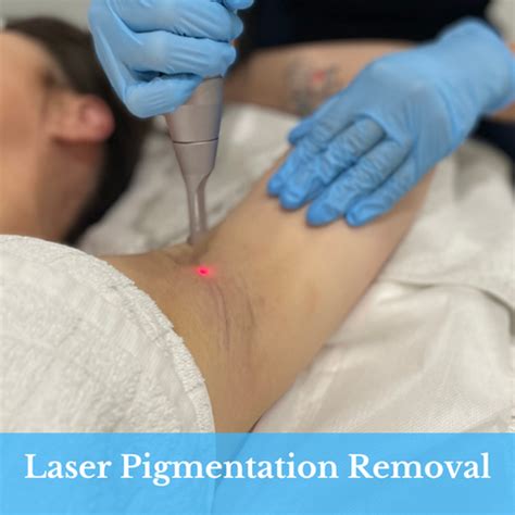 Laser Pigmentation Removal Aqua Laser Clinic