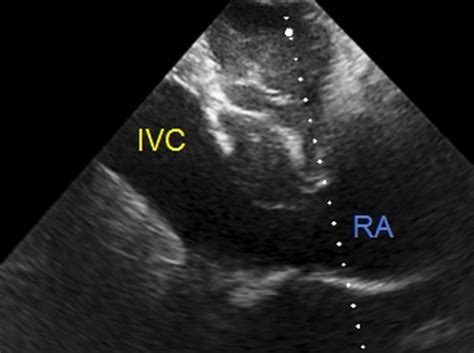 What Is Ivc Plethora In An Echo Report All About Heart And Blood Vessels