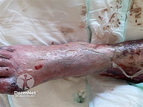 Purpura Fulminans Image