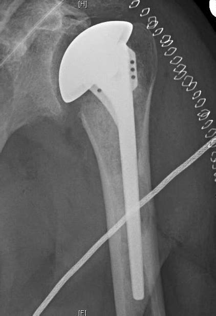 Uw Shoulder And Elbow Academy Painful Resurfacing Arthroplasty