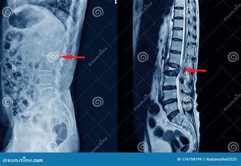 Medical X Ray Lumbar Spine Compression Fracture Bulging Of L1 2 Stock