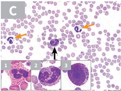 5张血涂片快速了解白细胞象和肥大细胞血症，快来看分析！粒细胞